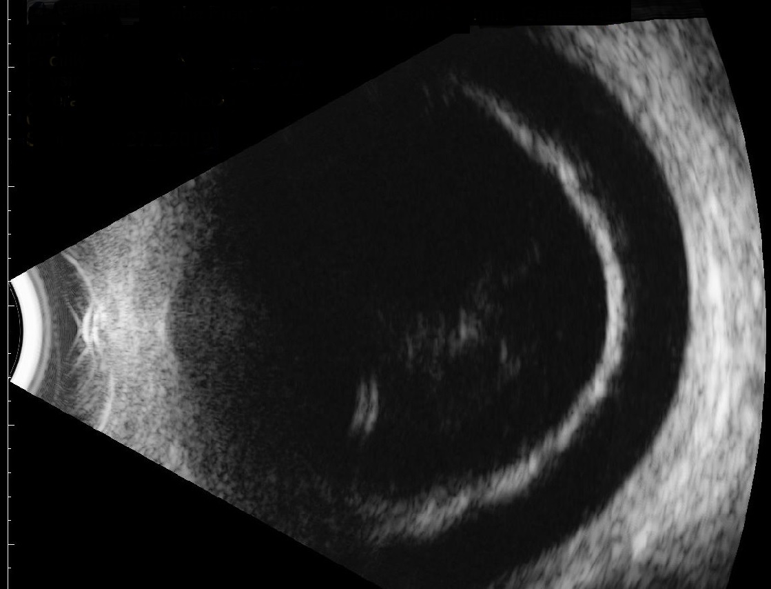 Odchlípení sítnice - Centrum Zraku - Blog